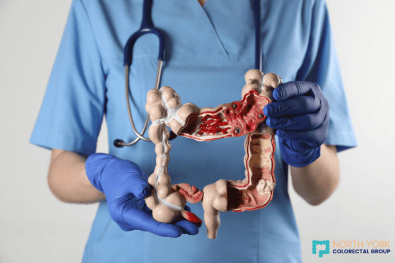 Colon Cancer: The Different Stages and What to Expect | North York ...